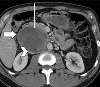 Madras Scans | CT Guided Biopsy In Chennai - Madras Scans