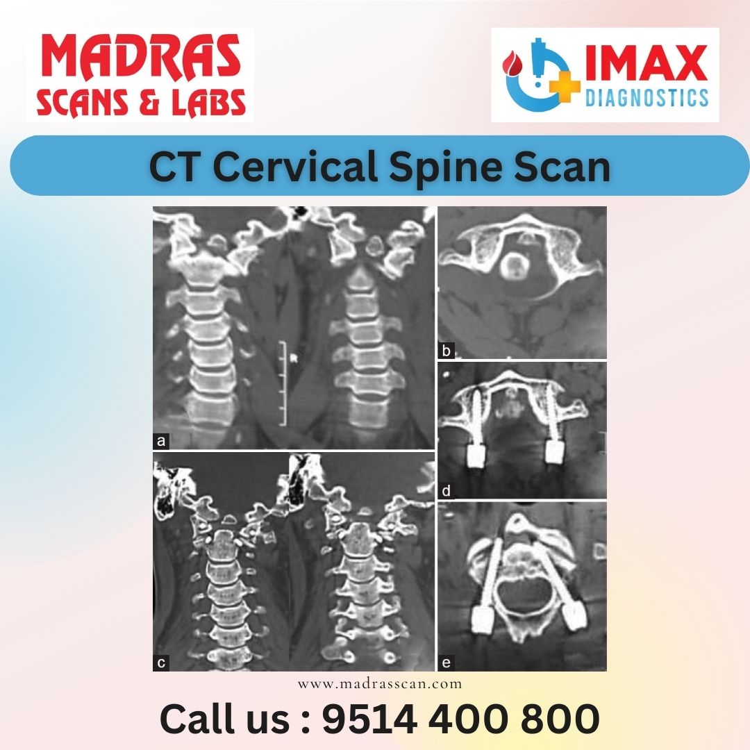 CT Cervical Spine Scan In Chennai - Madras Scans